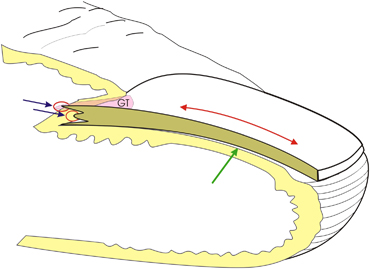 Inflamación y dolor muy fuerte en la cutícula de la uña principales ...