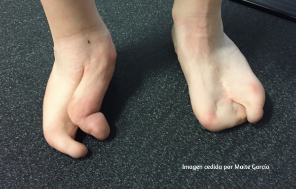 Ectrodactilia – ICOPCV